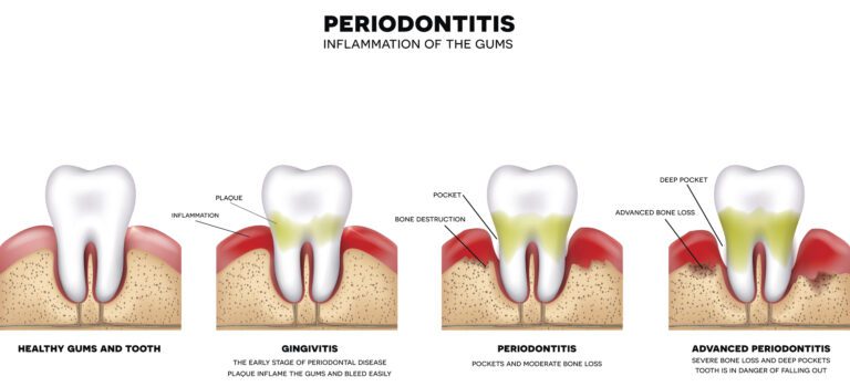 Arestin Treatment for Periodontitis San Antonio TX